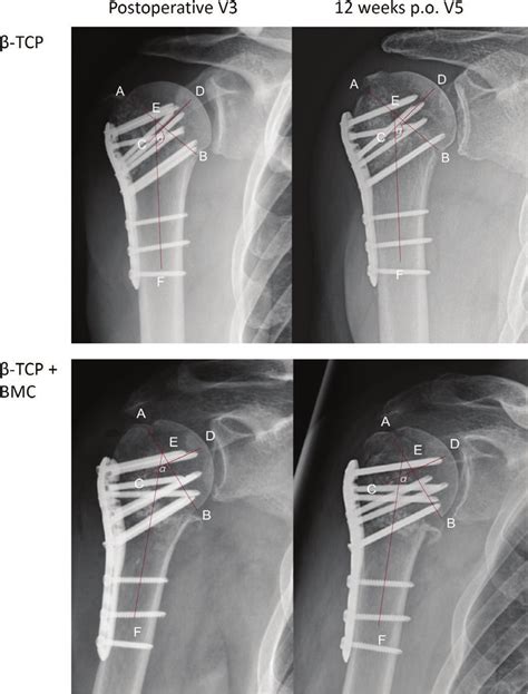 Representative Radiographs Of Surgically Treated Proximal Humerus