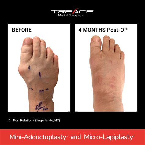 Learn About Micro Lapiplasty™ And Mini Adductoplasty Treace Medical