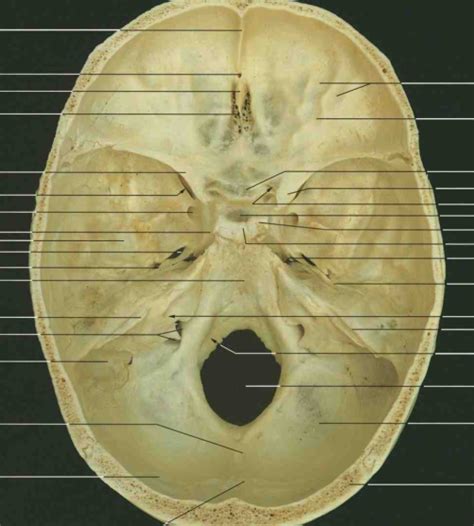 Superior Orbital Fissure Practical Examination ~ Shortcuts Of Human