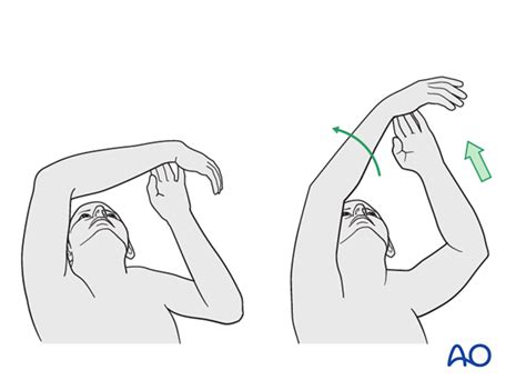 Orif Plate Fixation Proximal 1 3 For Multifragmentary Fracture Fragmentary Segment