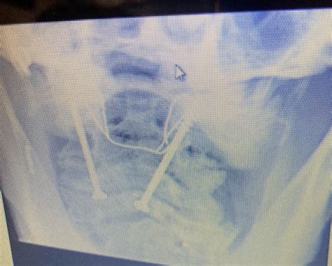 X Rays Of My Dads Neck From A Few Months Before He Passed Away His