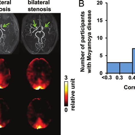 A Resting State Rs And Co 2 Inhalation Cerebrovascular Reactivity Download Scientific