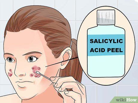 How To Quickly Reduce Pimple Size With Images Mytour