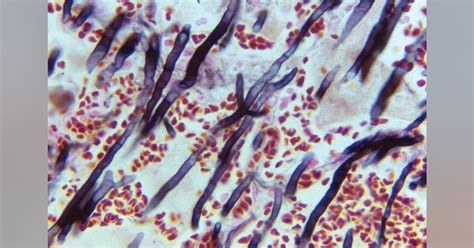 Review Of Laboratory Diagnostic Tests For Invasive Aspergillosis Mlo