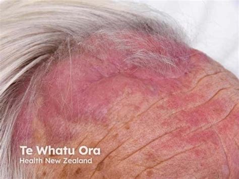 Cutaneous B Cell Lymphoma Image