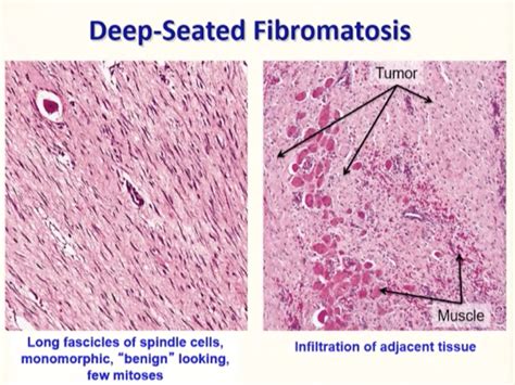 Soft Tissue Sarcoma Ppt