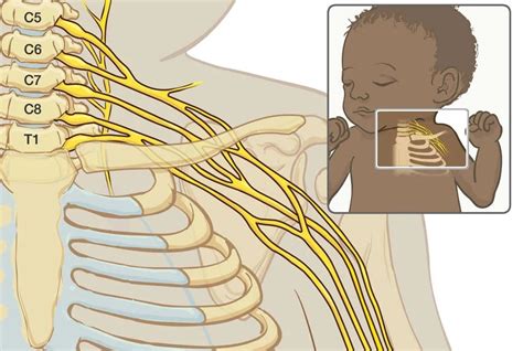 Erb Duchenne Palsy Nerve Affected