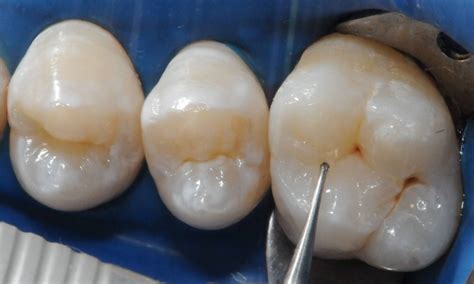 Clinical Protocol For Application Of Pit And Fissure Sealant Fgm Dental Group