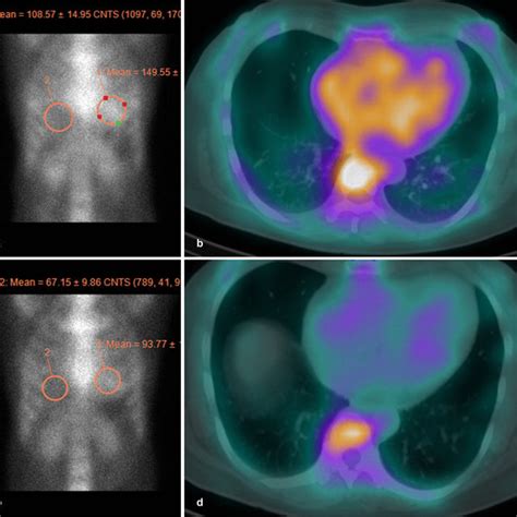 99mtc pyp cardiac scintigraphy using planar semiquantification and