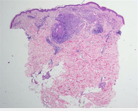 Hande Photomicrograph At Low Power Showing A Nodular Infiltrate In The Download Scientific