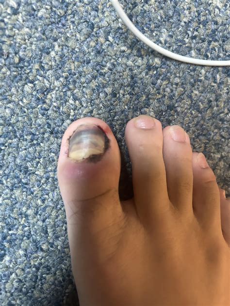 Pyoderma Gangrenosum On My Mothers Leg R Makemesuffer