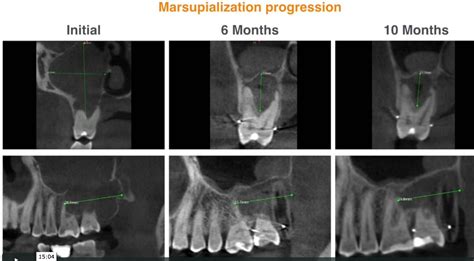Decompression Marsupialization Technique For Management Of Maxillary Odontogenic Keratocyst