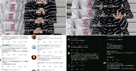 人気女性youtuber 関根りささん、去年生まれた長男が難病「接合部型表皮水疱症」であることを公表 →国内では症例も少なく治療環境も未整備