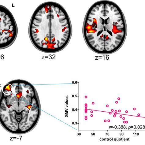 Patterns Of Rolandic Region Associated Structural Covariance Networks