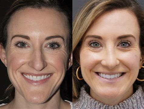 Chin Reduction Beverly Hills Ca And Los Angeles Dr Sykes