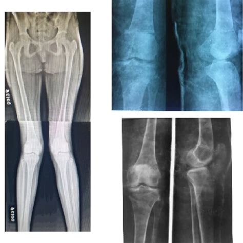 Serial Radiographs In A 16 Year Old Pre Operatively Immediate Post Op