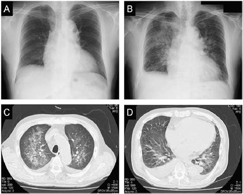 Cephalization Definition Chest X Ray At Frank Jobe Blog