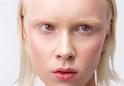 Ocular Albinism Treatment