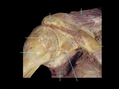 Joints Coracoacromial Ligament Diagram Quizlet