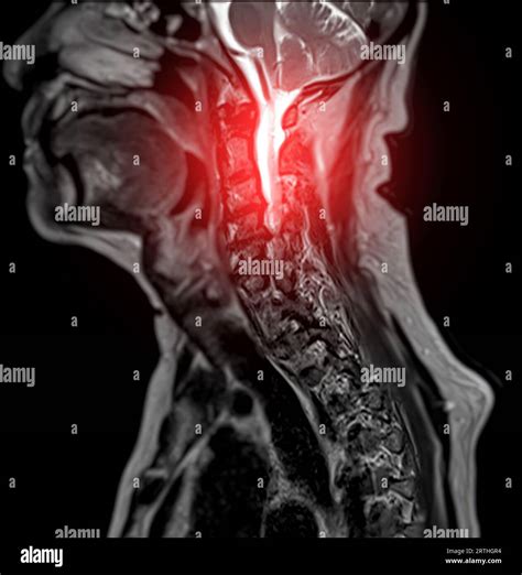 IRM du rachis cervical ou imagerie par résonance magnétique de la vue sagittale T2 FS du rachis ...