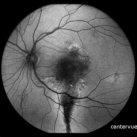 Icare Eidon Af Confocal Scanner Mainline Instruments