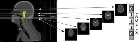 an example of projecting segmented slices into a list of labels where