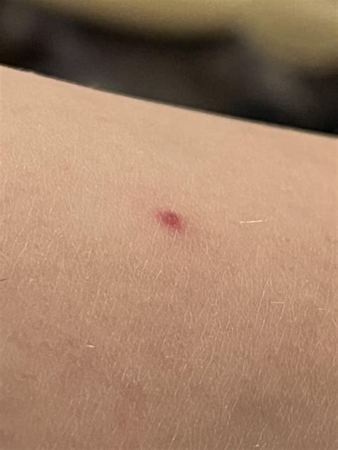 Anyone Have Any Idea If This Is A Bite Or A Pimple R Bugbite