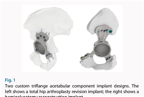 Figure 1 From High Accuracy Of Positioning Custom Triflange Acetabular Components In Tumour And