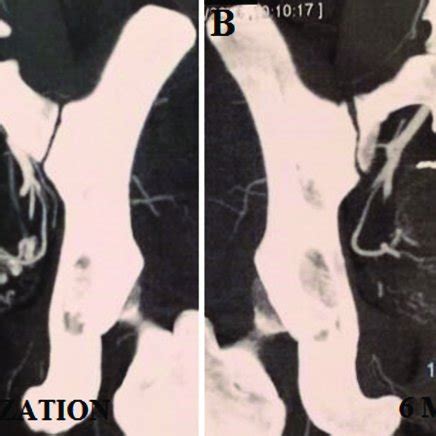 A Pre Embolization CT Angiography Demonstrating The Download Scientific Diagram