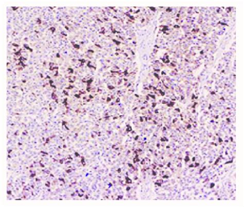Immunohistochemistry Stain Positive For Vasoactive Intestinal