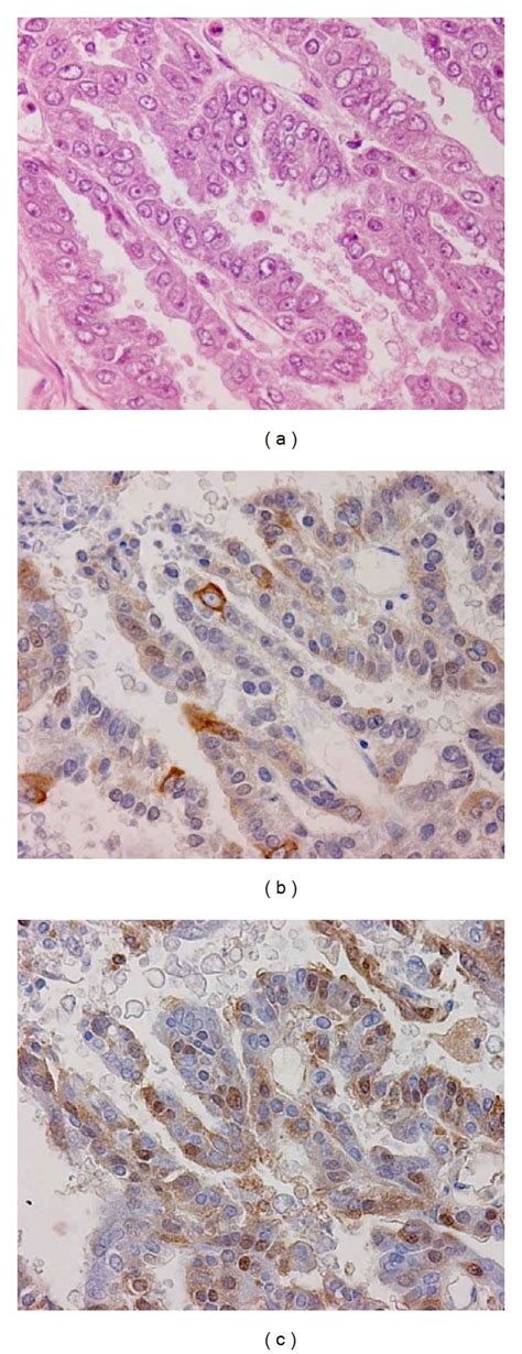 Papillary Serous Carcinoma Of The Peritoneum Pscp Neoplastic Cells Download Scientific