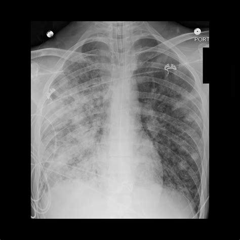 Pediatric Pulmonary Fat Embolism Pediatric Radiology Reference