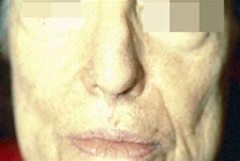 Nasal Reconstruction Archives Robert A Guida Md Pc