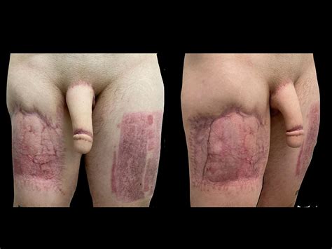 Phalloplasty Before And After Photos Drew Marano Md And Jonathan Keith Md Facs New York Ny