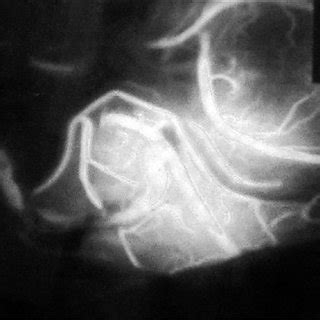 Intra Operative Icg Angiography After Superficial Temporal Artery To