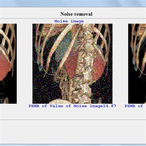Matlab Simulation Results For Axial Ct Of Abdomen And Pelvis Medical