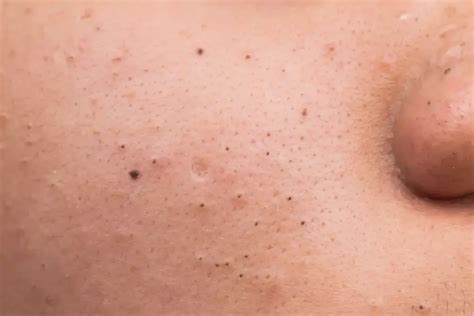 How To Remove Severe Blackheads Complete Extraction Guide