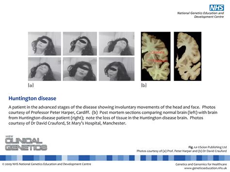 Clinical Photos Autosomal Dominant Conditions Ppt