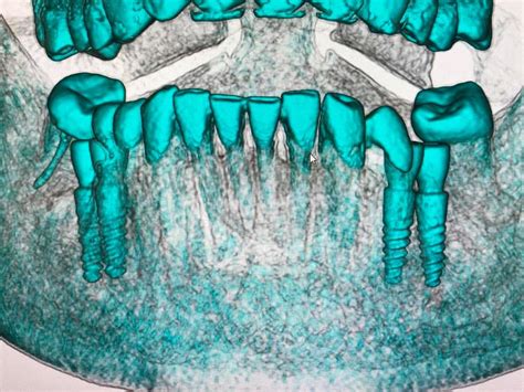Имплантация и протезирование зубов в Минске