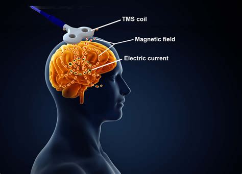 Improved Transcranial Magnetic Stimulation Coil With Enhanced Placement