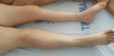 Significant Atrophy Of The Left Lower Limb Source Document Obtained