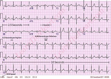Normal 12 Lead Ecg