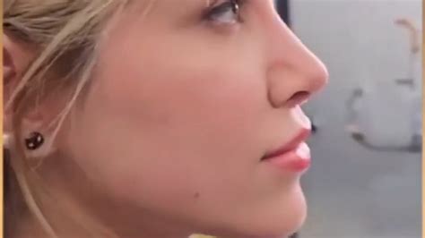 یک ماه بعد از جراحی زیبایی بینی با دکتر بشارتی زاده