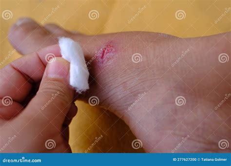 Closeup Of Wound On Patient Leg And Bleeding Due To Infection And