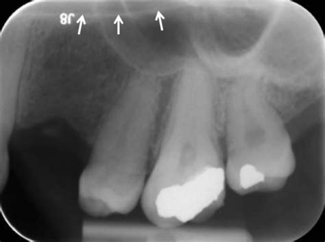 Imaging Of The Maxillary Antrum Flashcards Quizlet