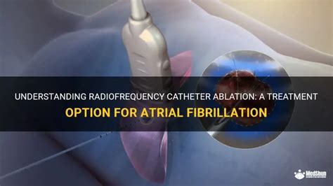 Understanding Radiofrequency Catheter Ablation A Treatment Option For Atrial Fibrillation Medshun