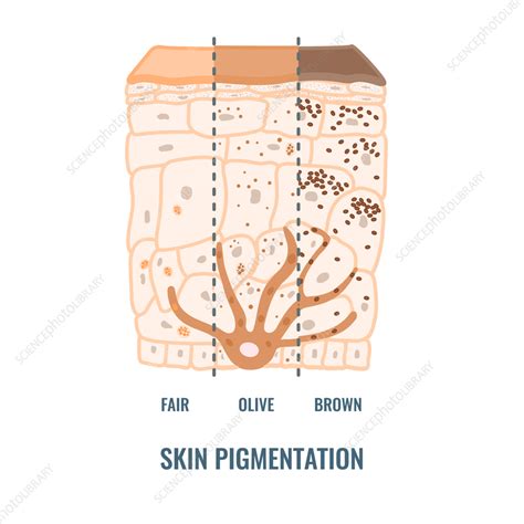 Skin Pigmentation Illustration Stock Image F0366176 Science Photo Library