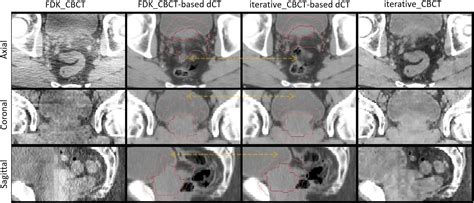 how does cbct reconstruction algorithm impact on deformably mapped targets and accumulated dose