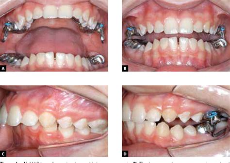 Figure 1 From Angle Class Ii Correction With Mara Appliance Semantic