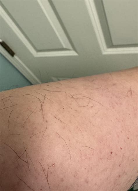 What Are These Small Red Dots On My Arms R Dermatologyquestions